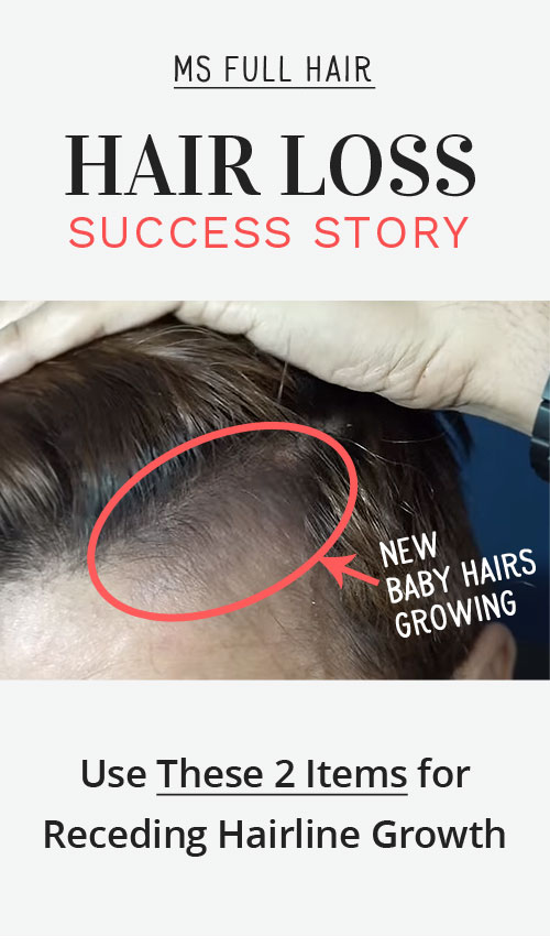 Use These 2 For Receding Hairline Natural Treatment